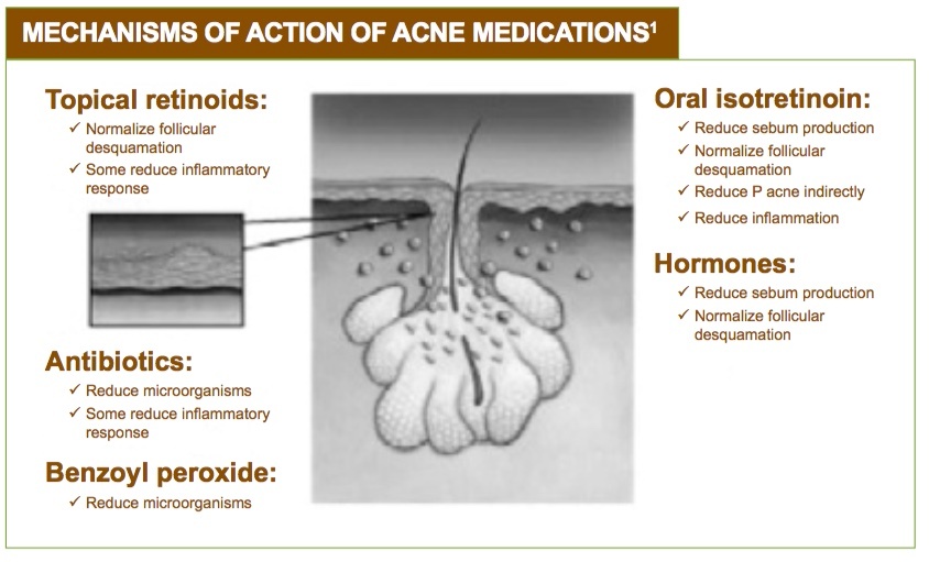 Acne Laser Treatment: A Fresh Approach to Treating Your Acne